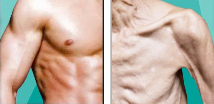 Prevención y gestión óptima de la sarcopenia: revisión de ...